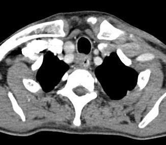 BLOG SCAN - RA Radiologistas Associados: TUMOR DE HIPOFARINGE E ESÔFAGO ...