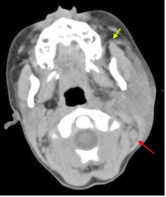 BLOG SCAN - RA Radiologistas Associados: PAROTIDITE AGUDA