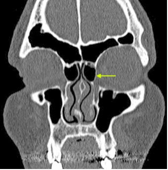 BLOG SCAN - RA Radiologistas Associados: O QUE FALAR DA CÉLULA AGGER NASI?