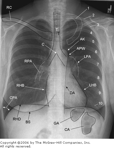 MEDICAL: Efusi pleura