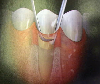 Kitchen and Residential Design: Root planing and curettage