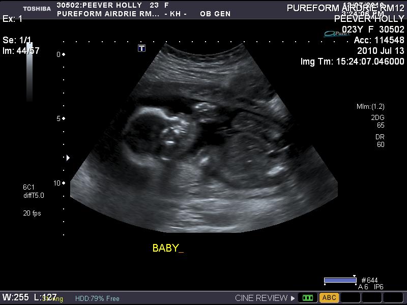 The Journey to Baby P..... AGAIN!: 19 week ultrasound