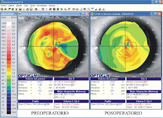 Camilo Gonzalez M.: TOPOGRAFIA CORNEAL