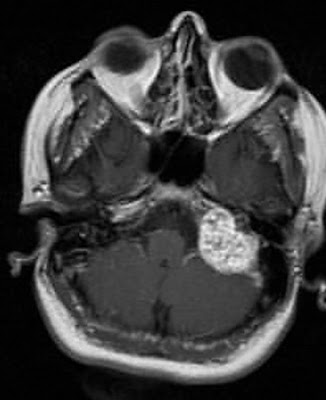 NEURORADIOLOGY: Salt and Pepper Sign