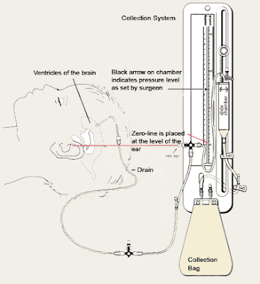 External Ventricular Drains (EVD or Ventriculostomy) - U of M ...
