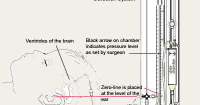Our Life And Such: The External Ventricular Drain