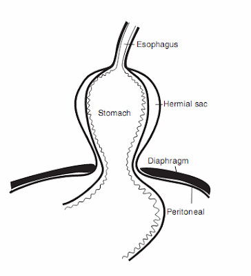 What is acid reflux?: What is Hiatal Hernia?