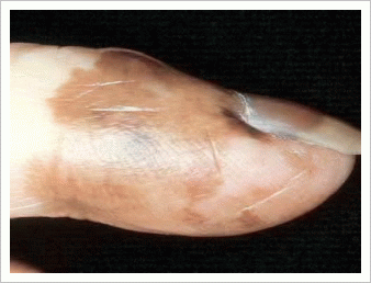 What is skin cancer?: What is Acral lentiginous melanoma