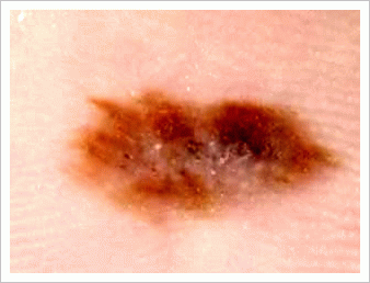 What is skin cancer?: What is Acral lentiginous melanoma
