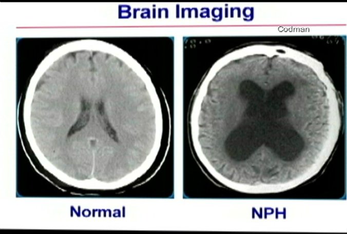 We Rage We Weep Memory Blog: NPH or Normal Pressure Hydrocephalus - Not ...