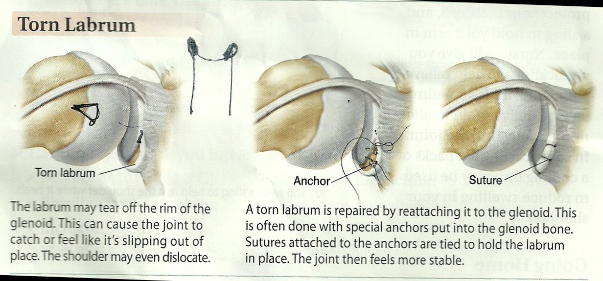 [DIAGRAM] Diagram Of Torn Labrum - MYDIAGRAM.ONLINE
