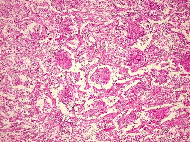Liga de Patologia - UFC: FEOCROMOCITOMA