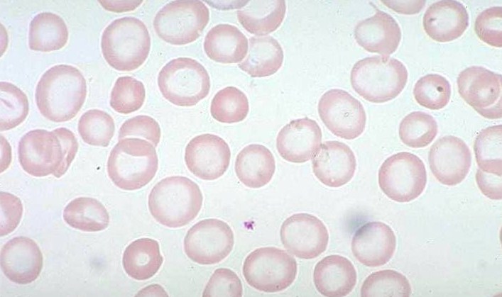 PATOLOGIA CLINICA: HEMATOLOGIA