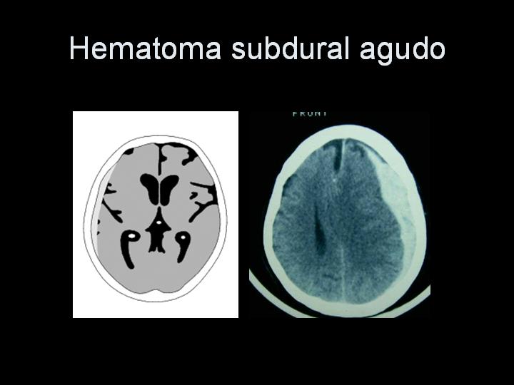 Hematoma subdural agudo; Hemorragia Subdural Aguda; Hematoma Agudo Subdural