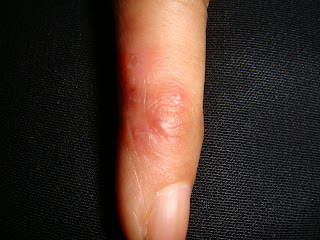 Skin Care Tips From Dermatologist: Herpetic Whitlow: An Occupational Hazard