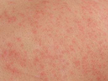 Fair Queens: Common Fungal Rashes and Infections