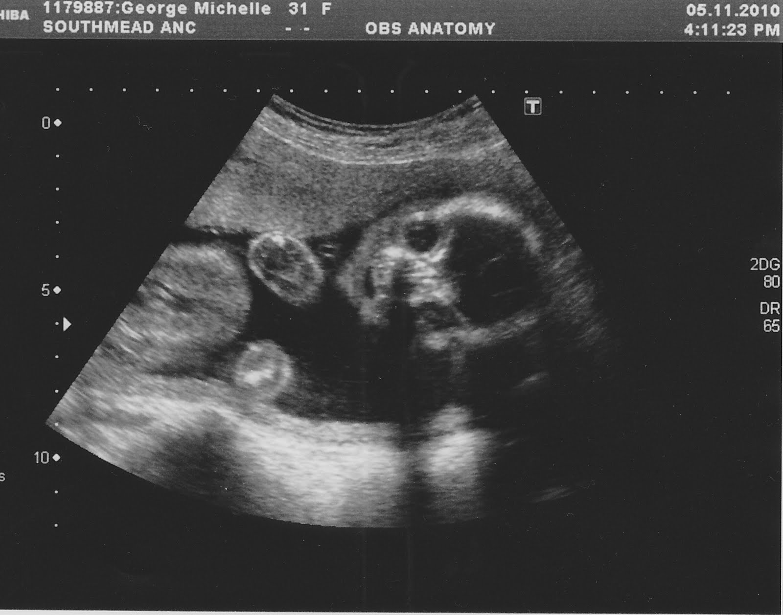 Growing Nugget: 20 WEEK SCAN - 24 WEEKS, 2 DAYS