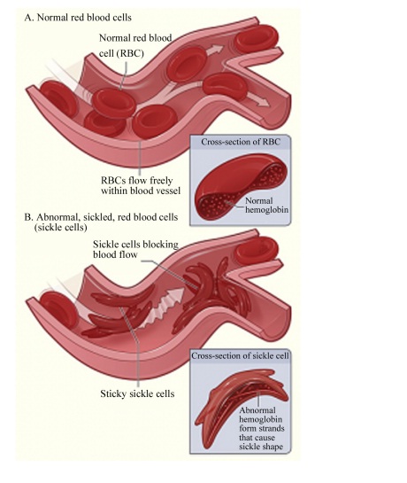 Falcemia: Practica Docente : La Falcemia