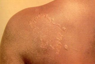 INFO AYUSH DARPAN: sporotrichosis