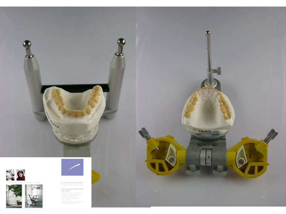 Implantdentistry and related topics: Wax up of study casts for correct ...