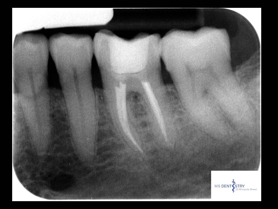 Implantdentistry and related topics: RCT tooth 36 - single session