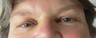 VERT-EL-SELS.: Brilhematoom