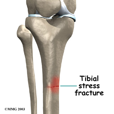Tibia Stress Fracture - kidsfasr
