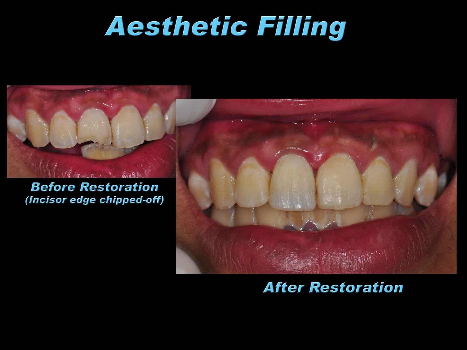 Prestige Dental Care: Aesthetic Filling