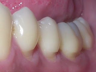 Oclusion II: Abfracciones