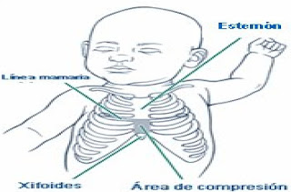 Reanimación Neonatal: Reanimación neonatal