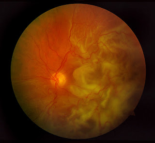 Mein Praktisches Jahr (PJ): Augenheilkunde - 2. Woche - "Ablatio Retinae"