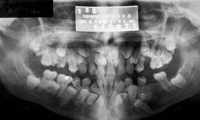 Rx Pics: CLEIDO-CRANIAL DYSPLASIA