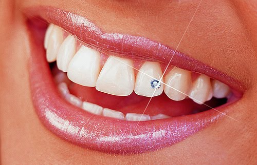 Rx Pics: DENTAL DIAMONDS