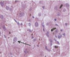 Anatomía Patológica: Inflamación celular