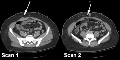 The Trauma Professional's Blog: Use of Abdominal CT in Stab Wounds to ...