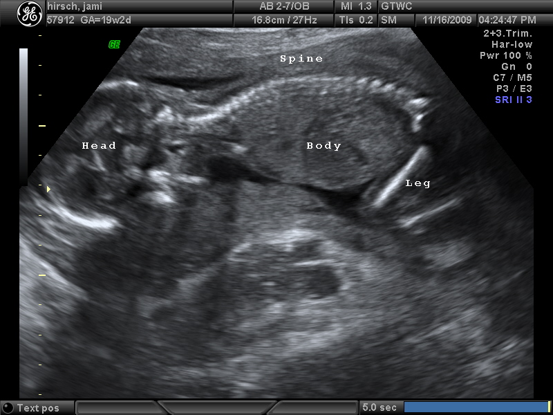 Lola Nicole Hirsch: 19 Weeks Ultrasound