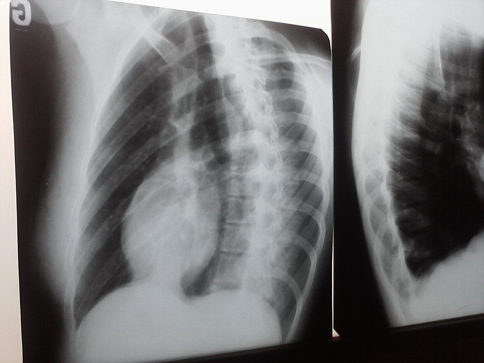 Rx 2010: Tórax Oblicuo Anterior Derecho e Izquierdo