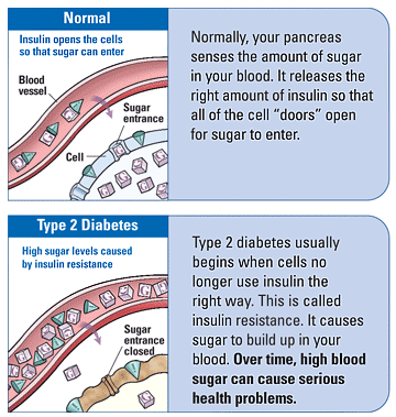 diabetesdisorder: Types of Diabetes