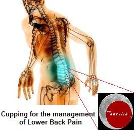 Ahealth: Cupping Therapy for Lower Back Pain by Anjum Shahzad