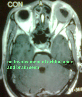 ummara shares: CA SUPRASTRUCTURE OF LEFT MAXILLARY ANTRUM