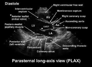 ummara shares: PARASTERNAL LONG AXIS VIEW ON ECHO