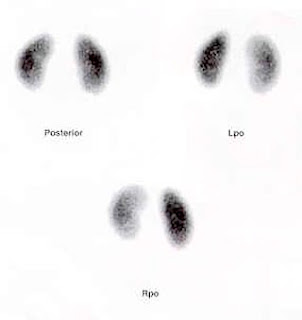 ummara shares: Normal DMSA renal study