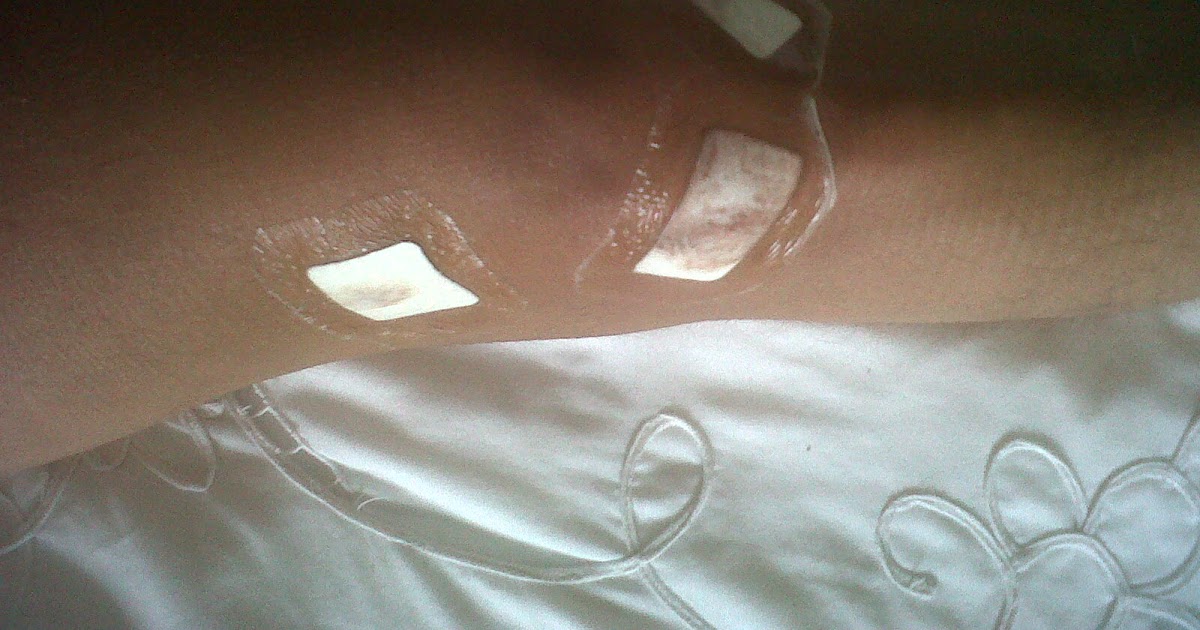 Plica Semilunaris Swollen, congenital anomaly of caruncula lacrimalis ...