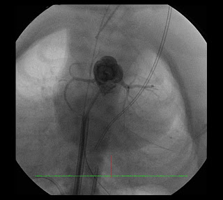 Pedi cardiology: Gen: Coronary Artery Anomalies in d-TGA, TOF, l-TGA...