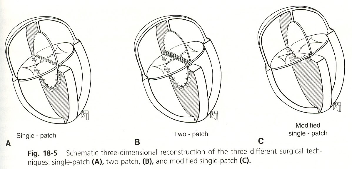 Pedi cardiology: Surgery: AVSD Repair Patch Types