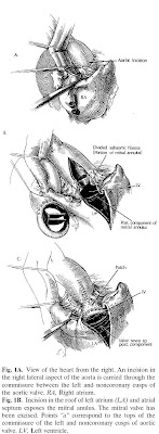 Pedi cardiology: Surgery: Konno, Ross-Konno