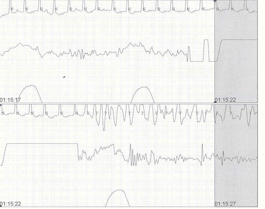 Pedi cardiology: V Fib