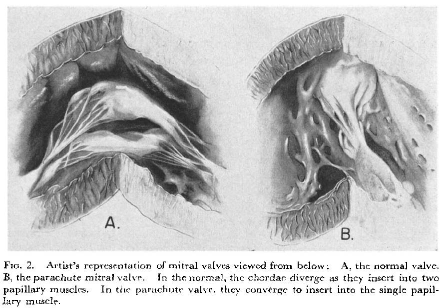 Pedi cardiology: Anatomy: Shone's Complex