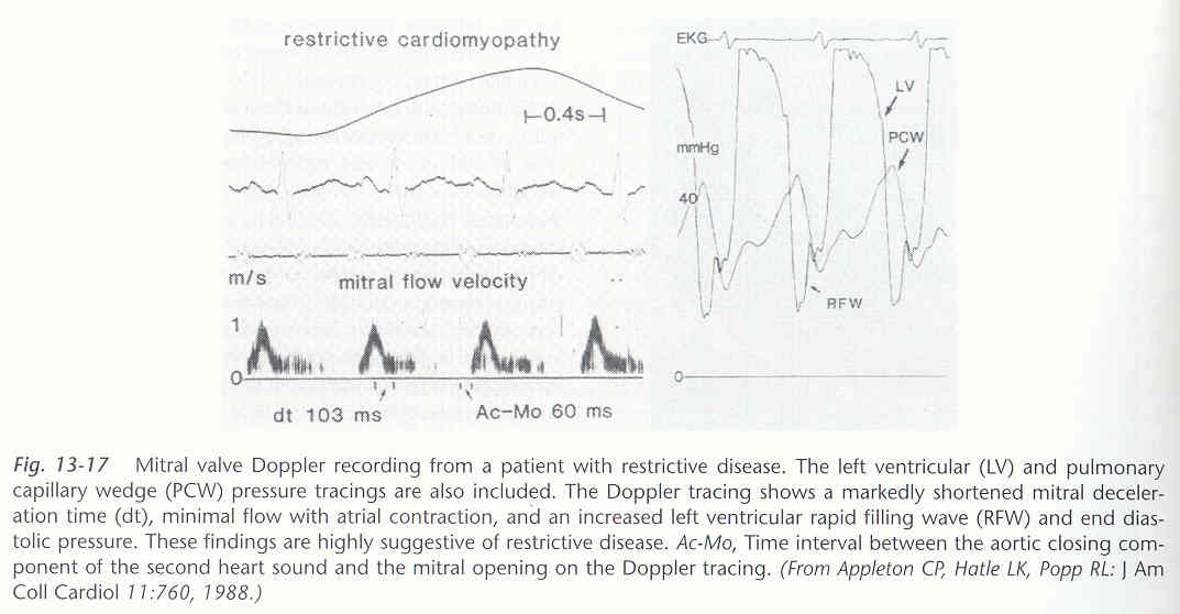 Pedi cardiology: Echo: Abnormal Ventricular Diastolic Function