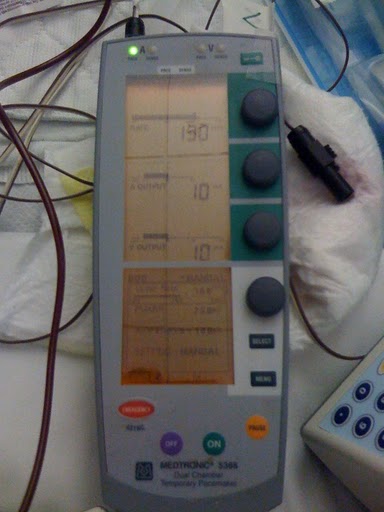 Pedi cardiology: ICU: Temporary Pacemaker